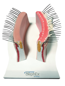 BlephEx™ | Blepharitis Treatment
