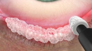 BlephEx™ | Blepharitis Treatment