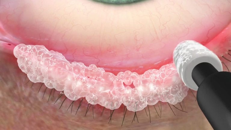 BlephEx™ | Blepharitis Treatment