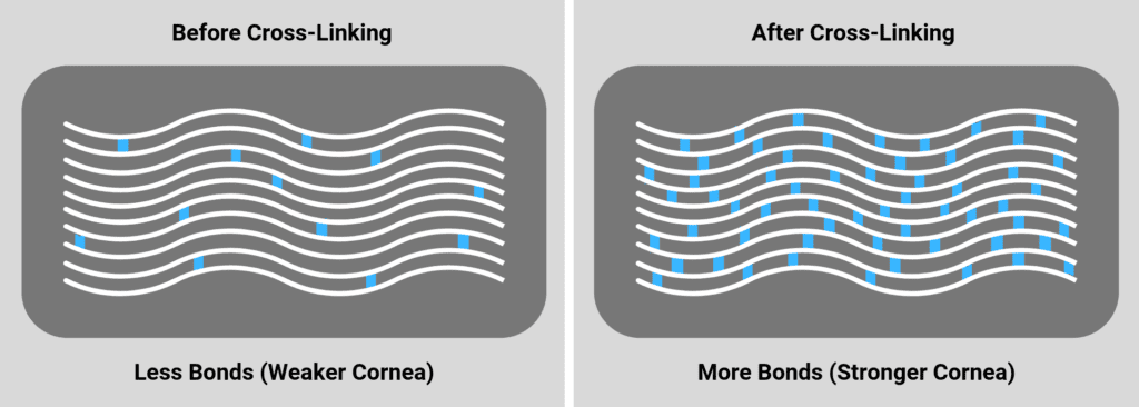 Corneal Collagen Cross-Linking