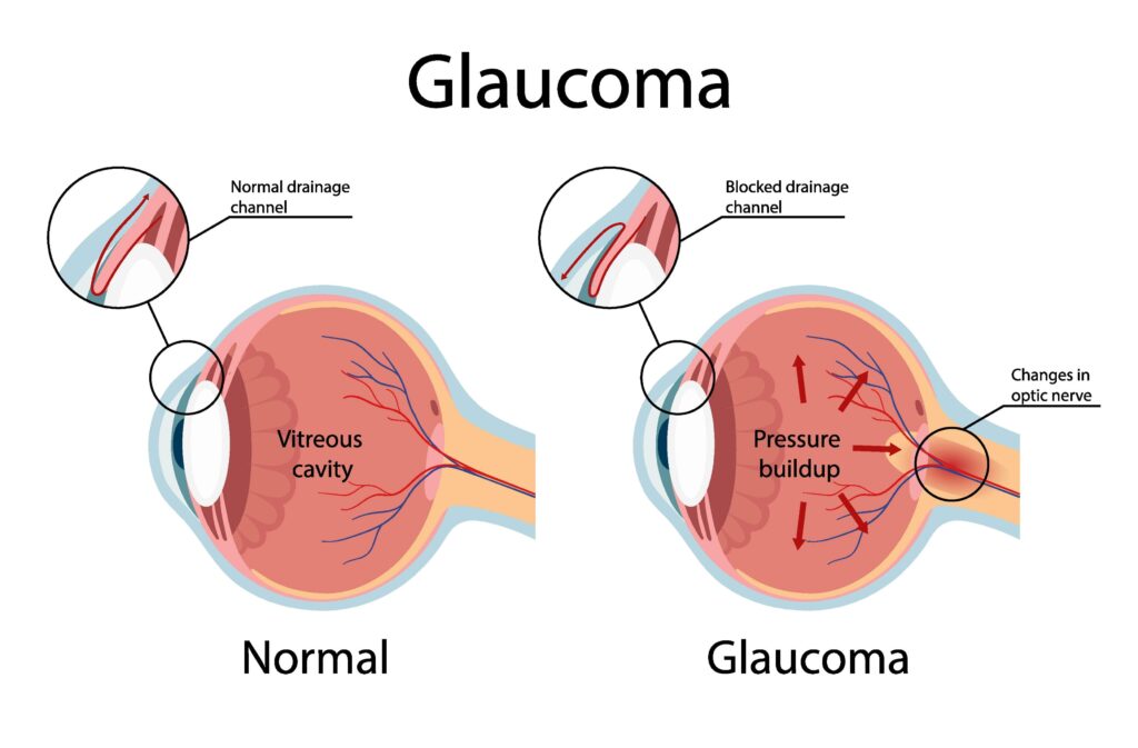 Managing Glaucoma: Medications, Laser Treatment, and Surgery