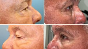 Oculoplastics: What Is It and What Does It Involve?