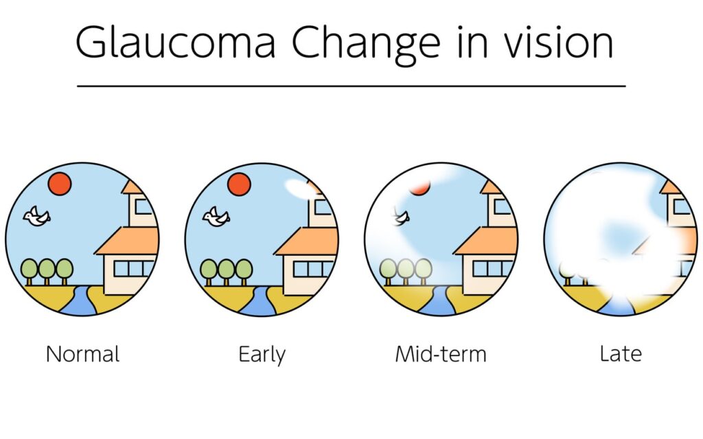 What To Do If You Suspect Glaucoma - Florida Eye