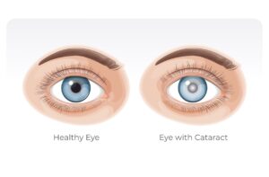 What to Expect Before, During, and After Cataract Surgery