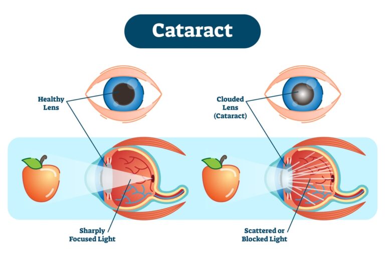 Understanding Causes, Symptoms, and Treatment for Cataracts